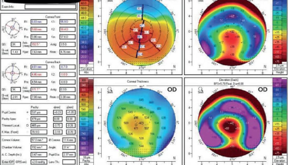 Dr Audrey Talley Rostov Managing The Un usual Keratoconus Patients Glaukos dr-audrey-talley-rostov-managing-the-un-usual-keratoconus-patients-glaukos